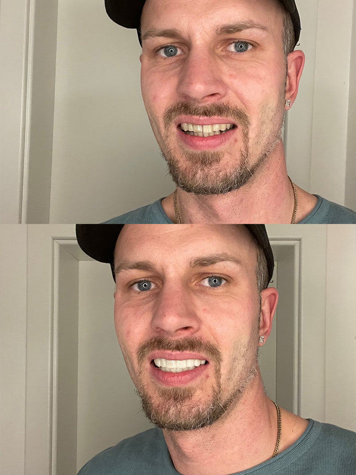 Snap-on Teeth Veneers – zynutra